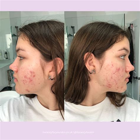How To Clear Up Hormonal Acne Fast Sofias Acne Journey