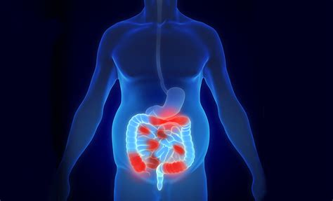 Diagnosing And Managing Ibd Medical Independent