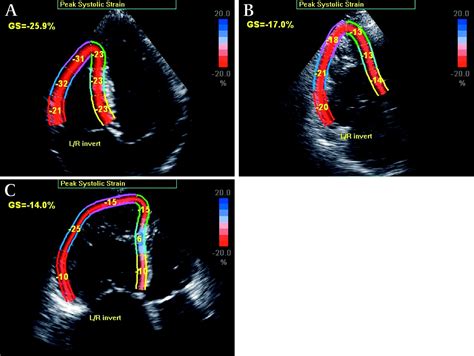 Two Dimensional Speckle Tracking Echocardiography Clinical