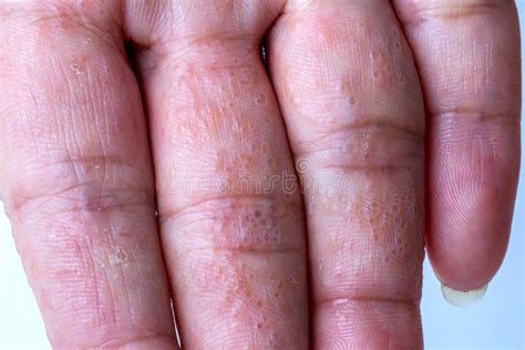 Close Up Atopic Dermatitis On Fingerad Also Known As Atopic Eczema