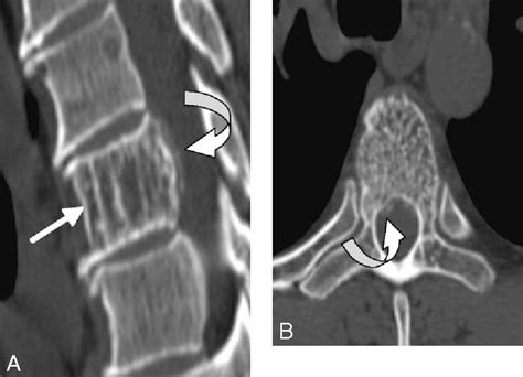 Figure 2 From A Minimally Invasive Vertebral Hemangioma Semantic Scholar