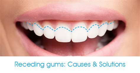 What Causes Receding Gums New Paradigm Dentistry