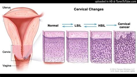 Cervical Squamous Intraepithelial Neoplasia Cin Conization Leep