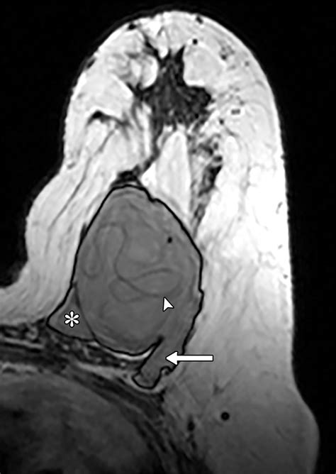 Multimodality Imaging Based Evaluation Of Single Lumen Silicone Breast