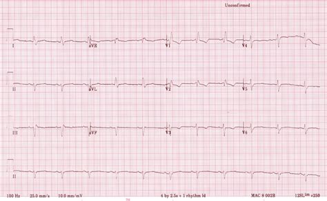 Bifascicular Block • Litfl • Ecg Library Diagnosis