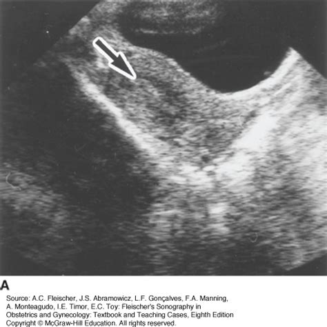 Sonographic Evaluation Of Uterine Disorders Obgyn Key