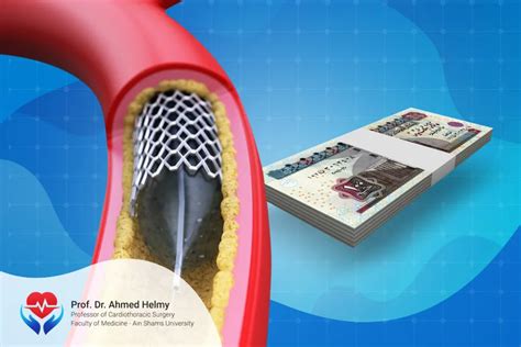 أسعار دعامات القلب وأنواعها الدكتور أحمد حلمي