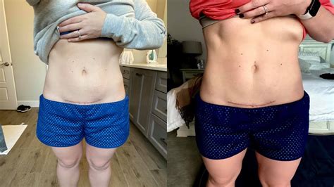 10 Incredible C Section Stories—and The Scars That Go 43 Off