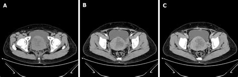 Uterine Tumor Resembling An Ovarian Sex Cord Tumor A Case Report And