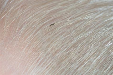 Head Lice And Nits Nhs
