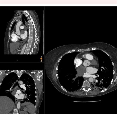 Chest Computed Tomography Revealing The Mass In The Left Atrium The
