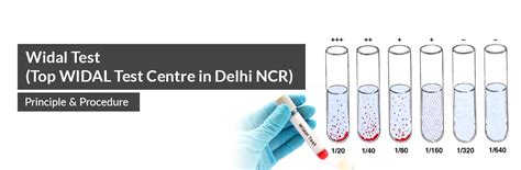 Widal Test Top Widal Test Centre In Delhi Ncr Principle And Procedure