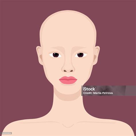 Young Woman With Alopecia Beautiful Bald Girl Alopecia Areata Vector