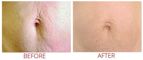 Micro Needling Skincare Tn Ms