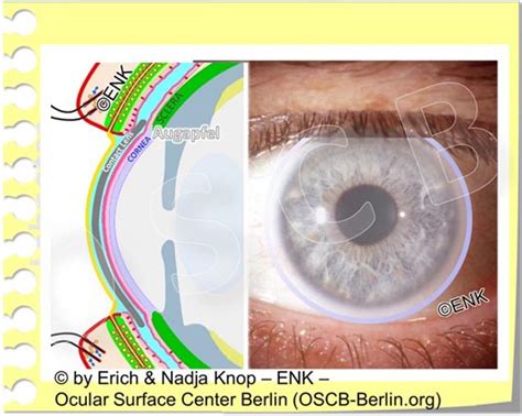 D Essentials Glimpse — Ocular Surface Center Berlin