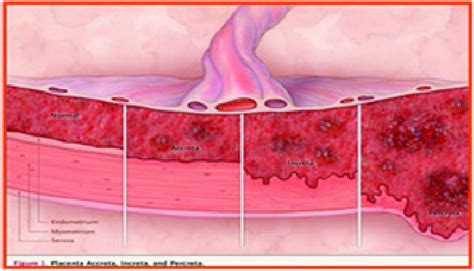 Placenta Accreta Increta And Percreta Download Scientific Diagram