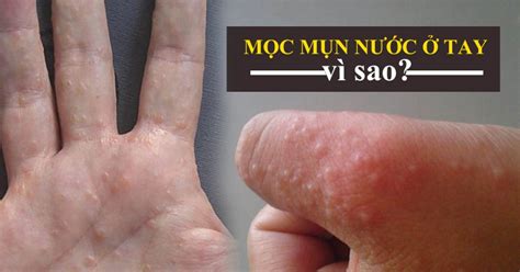 Mụn Nước ở Tay Là Gì Nguyên Nhân Và Cách điều Trị Dứt điểm