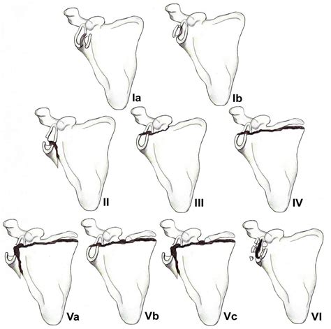 Scapula Fracture Causes Symptoms Diagnosis Treatment And Prognosis