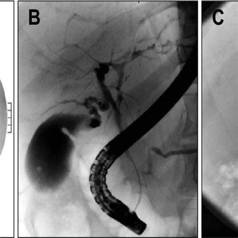 pdf igg4 related sclerosing cholangitis and primary sclerosing