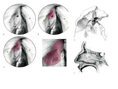 Functional Endoscopic Sinus Surgery