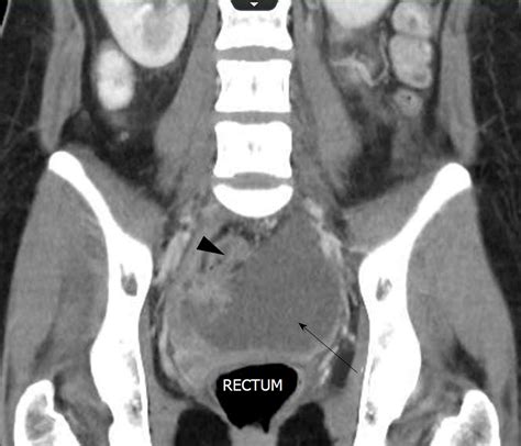 Post Appendectomy Pelvic Abscess With Extended Spectrum Beta Lactamase