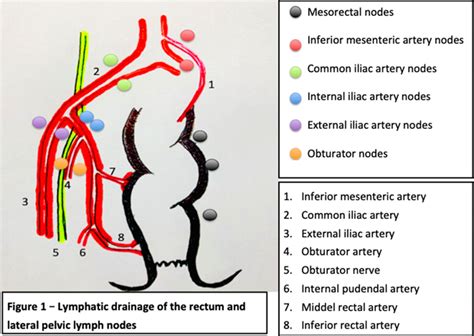 Lymphatic Drainage Of The Rectum And Lateral Pelvic Lymph Nodes
