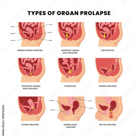 Set Different Types Of Organ Prolapse Diagram Scheme Infographic Poster