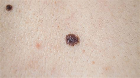 Melanoma Najafmyleene