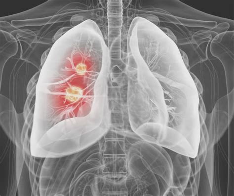 Adaura Trial Results Provide New Hope For Patients With Early Stage Non