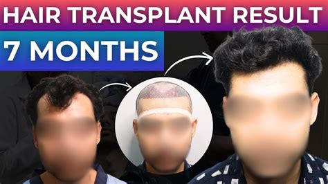 7 Months Hair Transplant Prp Session Hairmate Hair Transplant