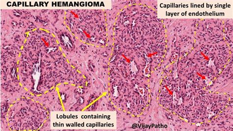 Capillary Hemangioma Pathology Made Simple