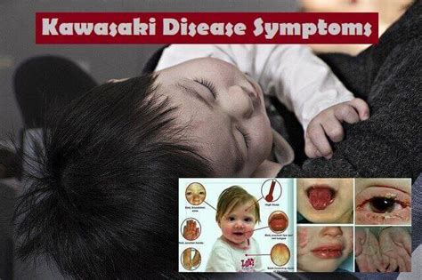 Kawasaki Disease 16 Symptoms Causes Diagnosis And Treatment 2024