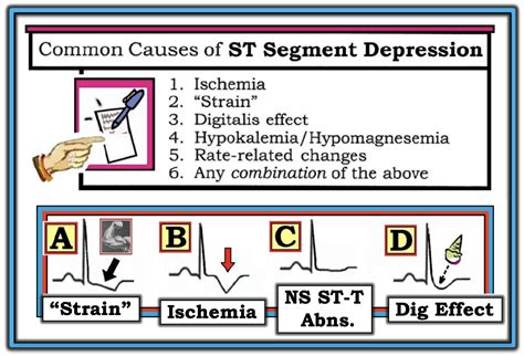 Dr Smiths Ecg Blog Is This St Depression Due To Lateral Ischemia