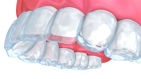 Overbite Overjet Differences Woodinville Wa Orthodontic Treatment