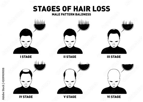 Hair Loss Stages And Types Of Male Hair Loss Male Pattern Baldness
