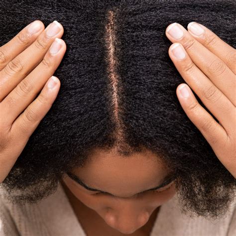 Dandruff Scalp