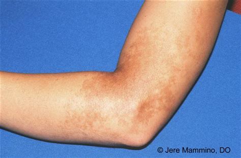 Beckers Nevus American Osteopathic College Of Dermatology Aocd