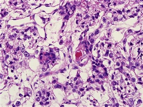 Histopathologic Examination Â400 Revealed Yolk Sac Tumor Color