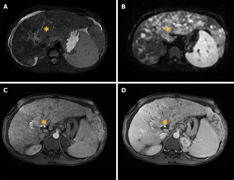 Pearls And Pitfalls In Magnetic Resonance Imaging Of Hepatocellular Carcinoma
