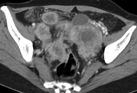 Axial Contrast Enhanced Computed Tomography Image Shows Enhancing