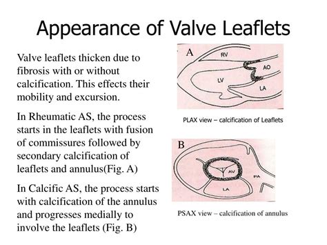Ppt Aortic Valve Disease Powerpoint Presentation Free Download Id