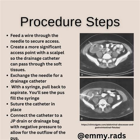 How To Drain An Intraabdominal Abscess 🦠💉 Gallery Posted By Em