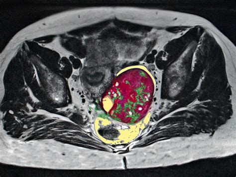 Ovarian Cyst On Mri