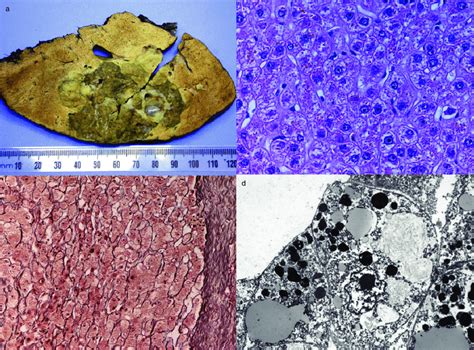 a gross right hepatectomy specimen showing centrally