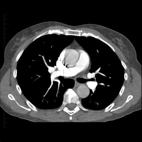 Ct Scan With Iv Contrast Patient Fact Sheet
