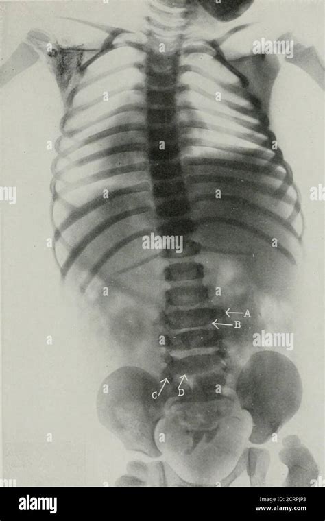Spina Bifida Occulta Fotos Und Bildmaterial In Hoher Auflösung Alamy
