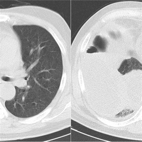 Chest Computed Tomography Scan Revealing Right Sided Massive Pleural