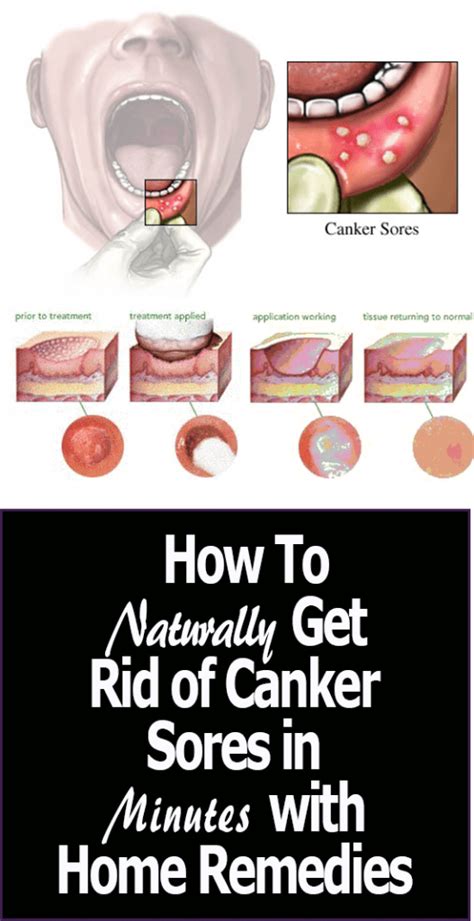 Home Remedies For Canker Sores