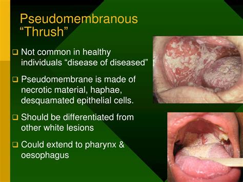 Ppt Fungal Infection Candidadiasis Candidosis Powerpoint