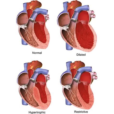 What Is Cardiomyopathy Know Its Symptoms Causes And Treatment Ganesh